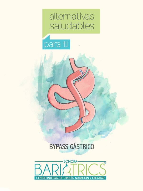 BYPASS GÁSTRICO – Sonora Bariatrics