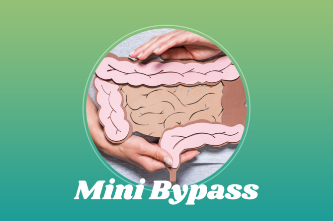 MINI BYPASS GÁSTRICO – Sonora Bariatrics