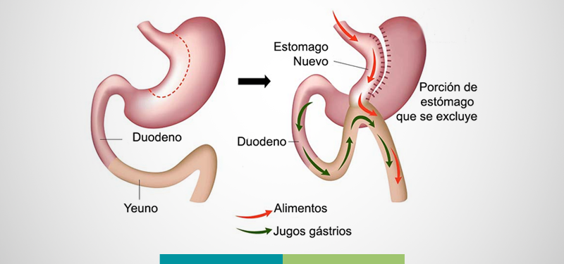 MINI BYPASS GÁSTRICO – Sonora Bariatrics